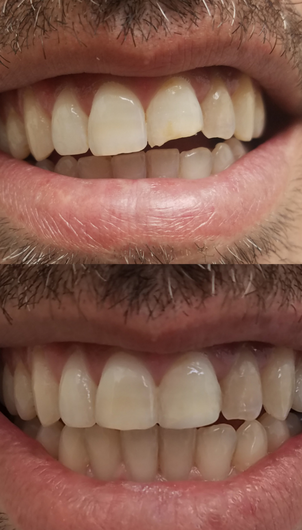 Fillings - Drubi Dental